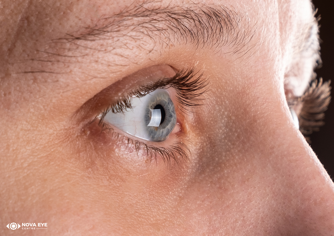 Common Eye Conditions Insight | Nova Eye Centre