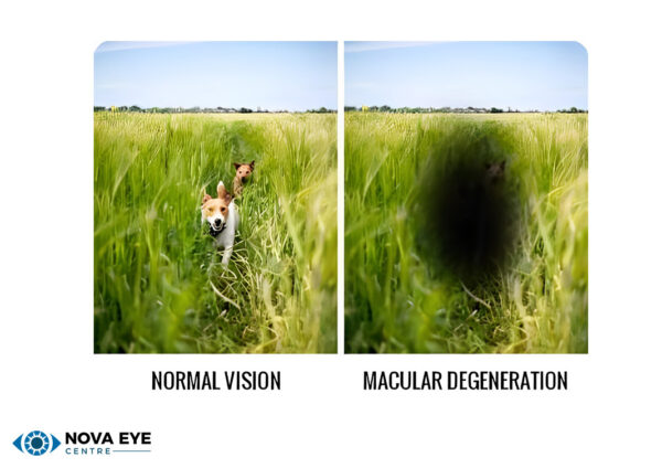 Symptoms of Macular Degeneration You Shouldn't Ignore